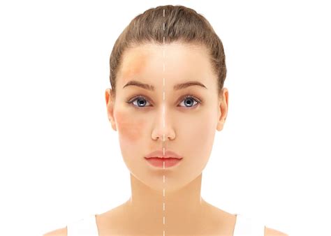 Hyperpigmentation Laser Treatment Melasma Laser Treatments