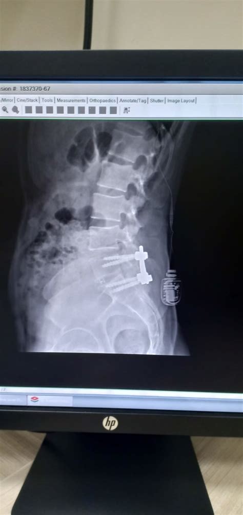 Xray Of My L5 S1 Fusion And Neurostimulator R Radiology