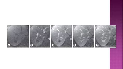 Focal And Diffuse Lesions Of Liver Pptx