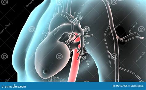 3d Medical Illustration Of Pulsatile Abdominal Aortic Aneurysm Stock