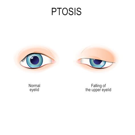 Ptosis Singapore Causes Costs And Treatment ⋆
