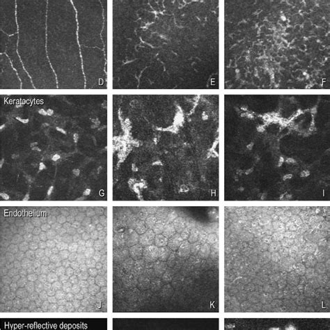 Subepithelial Infiltrates In The Donor Cornea Of Case 1 Arrows