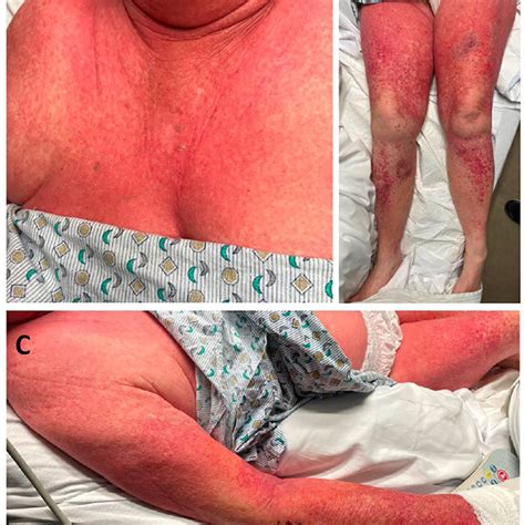 Diffuse Maculopapular And Blanchable Rash On A Chest B Legs And Download Scientific