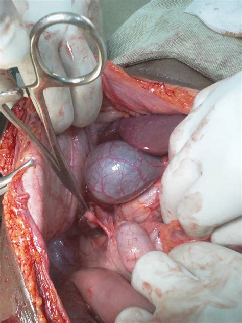 Perioperative View Of Subhepatic Appendix Download Scientific Diagram