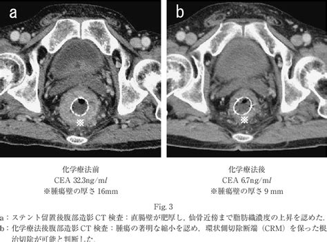 Table 1 From A Case Of Rectal Cancer Successfully Treated With Neoadjuvant Chemotherapy After