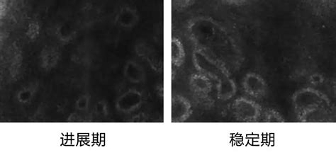 得了白癜风为什么需要进行皮肤CT检查 医学知识 菏泽白癜风医院 官网 成立于1993年的白癜风专科医院