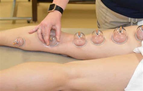 Cupping Therapy For Hamstring Myofitness