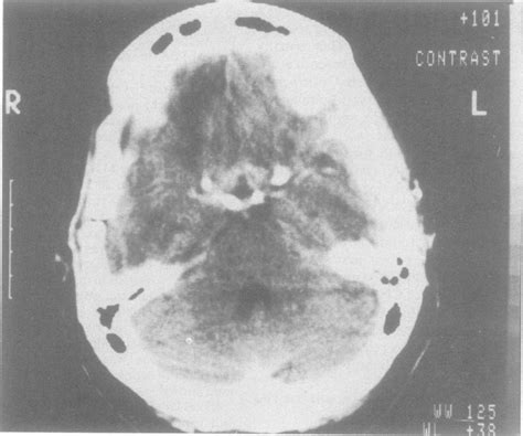 High Resolution Ctshows An Enhancing Mass In The Suprasellar Cistern