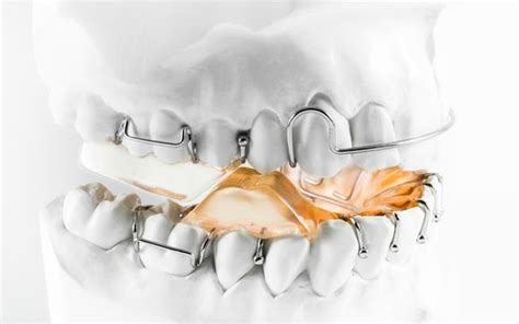 Bionator By Gaudi Orthodontics Inc In Calgary Ab Alignable