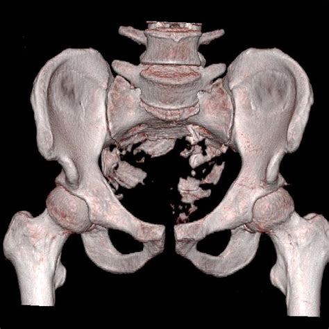 3 Dimensional Computed Tomography Of The Pelvis Reconstructed Image