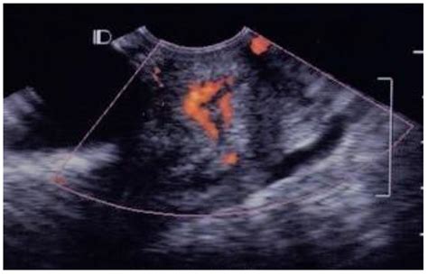 Cervicitis Ultrasound