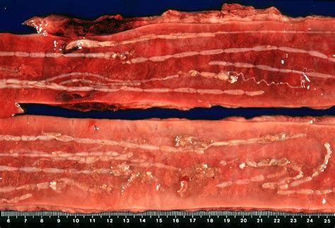 Flea Tapeworms Pathology And Ponies