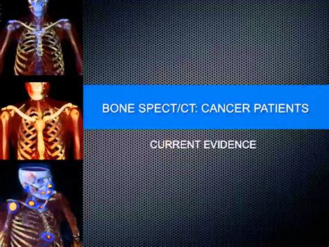 02 Bone Spect Ct In Patients With Cancer Youtube