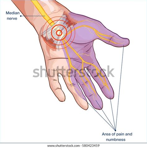 Transverse Carpal Ligament Compressed Median Nerve Stock Vector Royalty Free