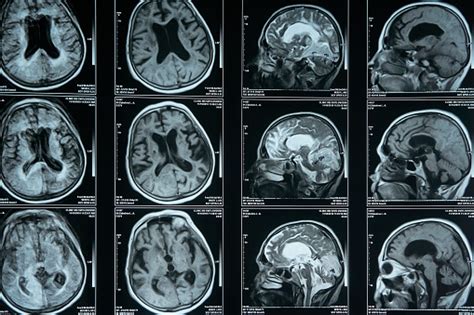 뇌의 클로즈업 Mri 이미지 뇌 질환의 진단 및 치료 인공 지능 세대 뇌에 대한 스톡 사진 및 기타 이미지 뇌 뇌전증