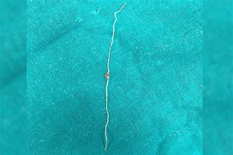 Mengerikan Parasit Tumbuh Di Pipi Wanita Ini Setelah Digigit Nyamuk