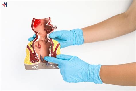 Effective Hemorrhoid Treatment Options Remedies Healthcare 360 Magazine