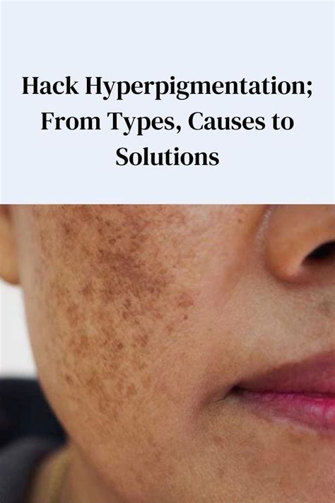 Hyperpigmentation And Dark Spots Hyperpigmentation Spots On Face