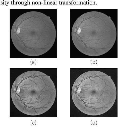 Figure 1 From Segmentation Of Retinal Vessels Based On Densenet Attention Unet Model Network