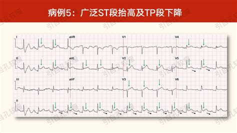 急性心包炎心电图表现有哪些 好医术文章 好医术 赋能医生守护生命