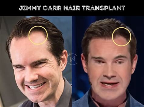 Jimmy Carrs Hair Transplant Jimmy Carrs Transformation Hair