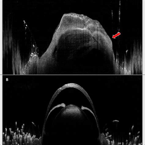 A Oct Image Of Right Eye Treated With 5 × 10 5 Um Scc 1 Cells Oct Download Scientific