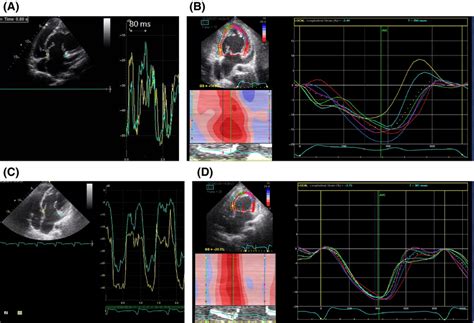 Tissue Doppler Imaging And 2‐dimensional 2d Speckle Tracking