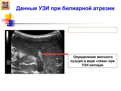 Пороки развития и заболевания желчных протоков и желчного пузыря у детей презентация онлайн