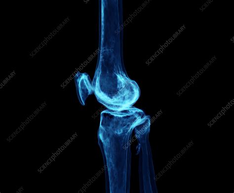 Knee Ct Scan Stock Image F0372747 Science Photo Library