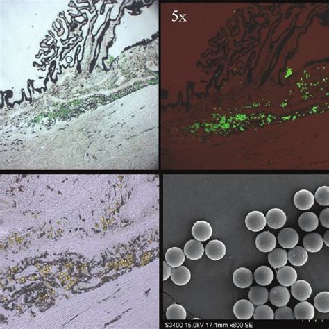 ‘inverted Hypopyon Emulsified Oil In The Anterior Chamber Download