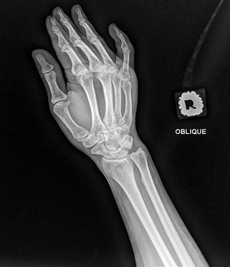Closed Fracture Of Right 5th Proximal Phalange Uni Clinic