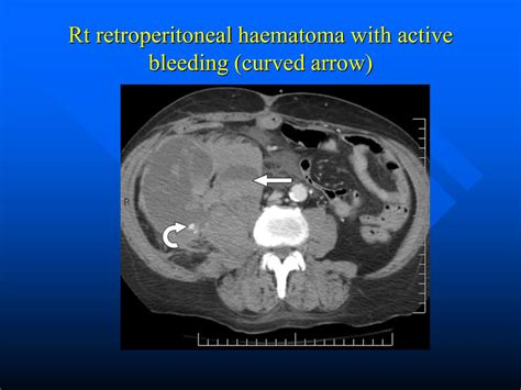 Retroperitoneal Hematoma Types And Management The Lectppt
