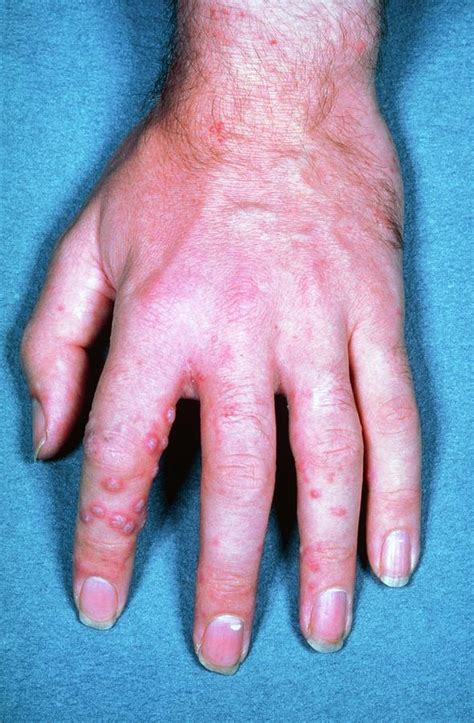 Mild Shingles On Hand