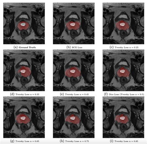 Github Ceragoguztuzun Semantic Segmentation Of Prostate Gland Mri