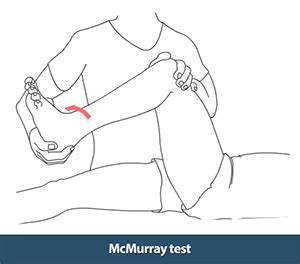 Meniscus Tear Cause Symptoms Treatment Mobile Physio