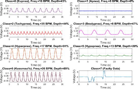 Figure 2 From Evolutionary Optimization Of 1d Cnn For Non Contact Respiration Pattern