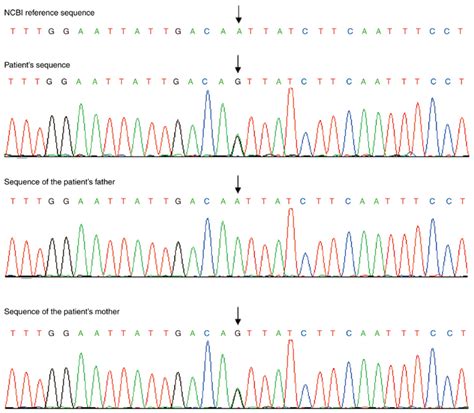 Sequence Trace Of Wes In Genetic Testing The First Chromosomal