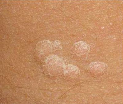 Little White Scaly Spots On Skin