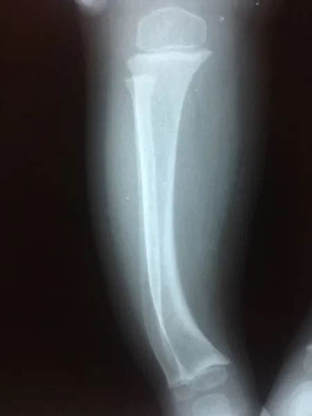 Tibia Varum Robert Sheinberg Dpm Weston Fl Podiatrist Tibia Varum Robert Sheinberg Dpm Weston Fl Podiatrist