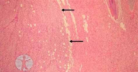 Fibrosarcoma Pathology Image
