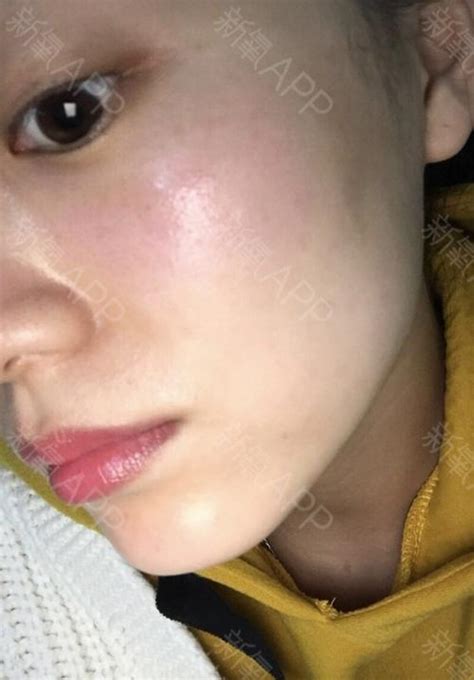光子嫩肤两次效果图 配图网