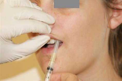 Periorbital Nerve Blocks Supraorbital Supratrochlear And