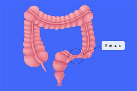 Colon Stricture In Crohns Disease