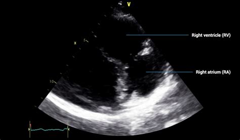 Echo Basics Parasternal Views • Litfl • Radiology Library