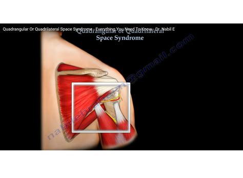 Quadrilateral Space Syndrome —