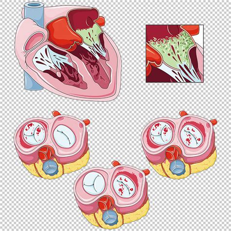 Vector De Endocarditis