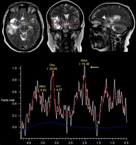 Primary Gliosarcoma A Rare Variant Of Wild Type Isocitrate
