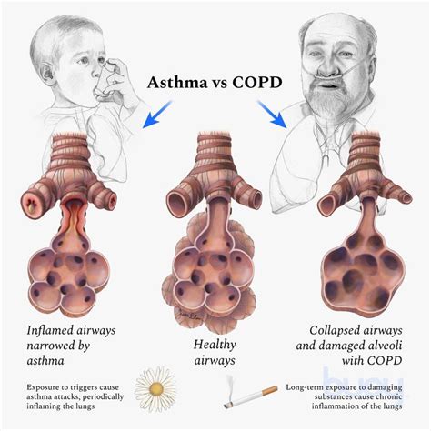 Difference Between Asthma And Copd On Spirometry At Samuel Unwin Blog