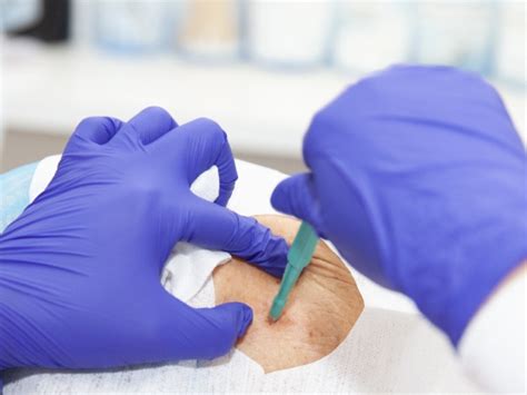 Skin Biopsy МЦ Марковс