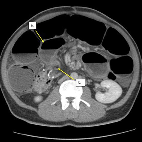 Axial Ct Demonstrating A Dilated Fluid Filled Small Bowel Loops Up